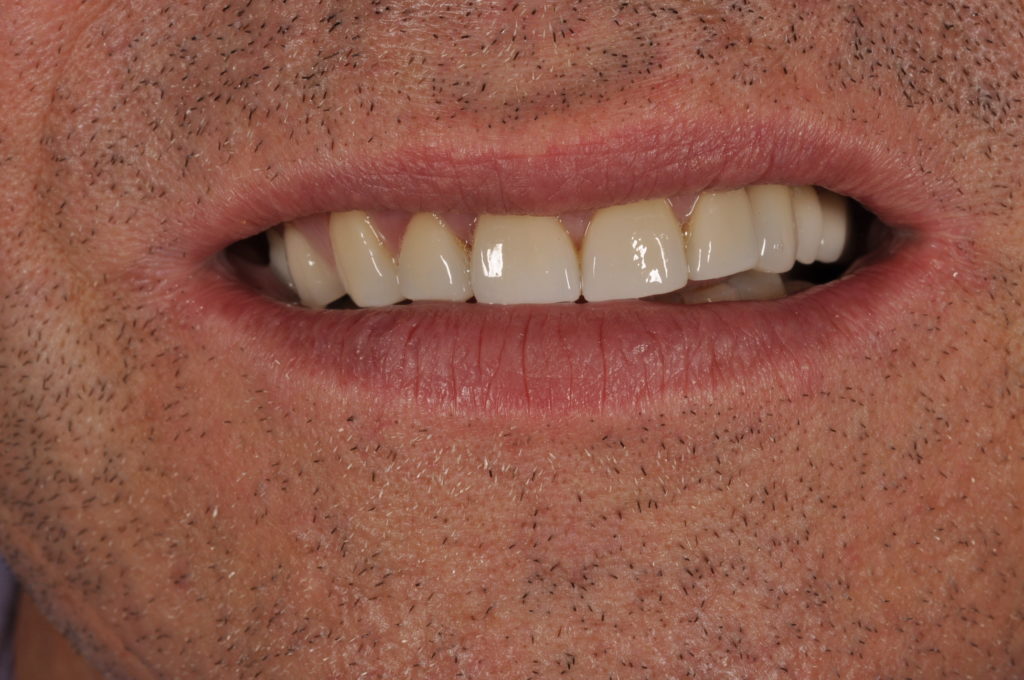 Partial and crowns complete 2 | Old Hook Dental